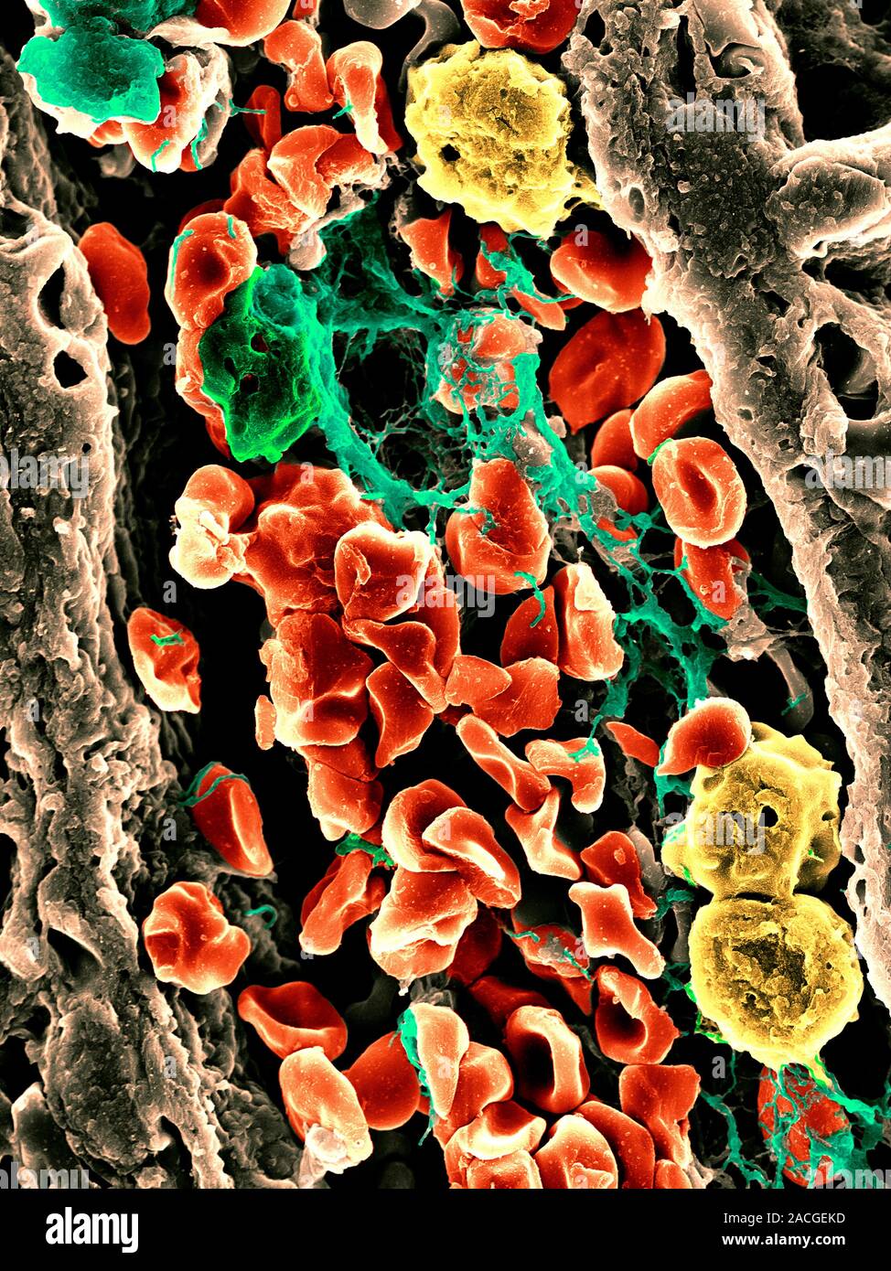 Blood clot. Coloured scanning electron micrograph (SEM) of red blood ...