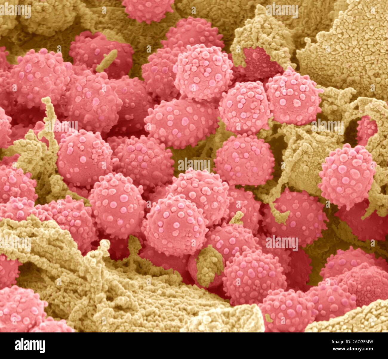 Lymphocytes in skin disorder, coloured scanning electron micrograph ...