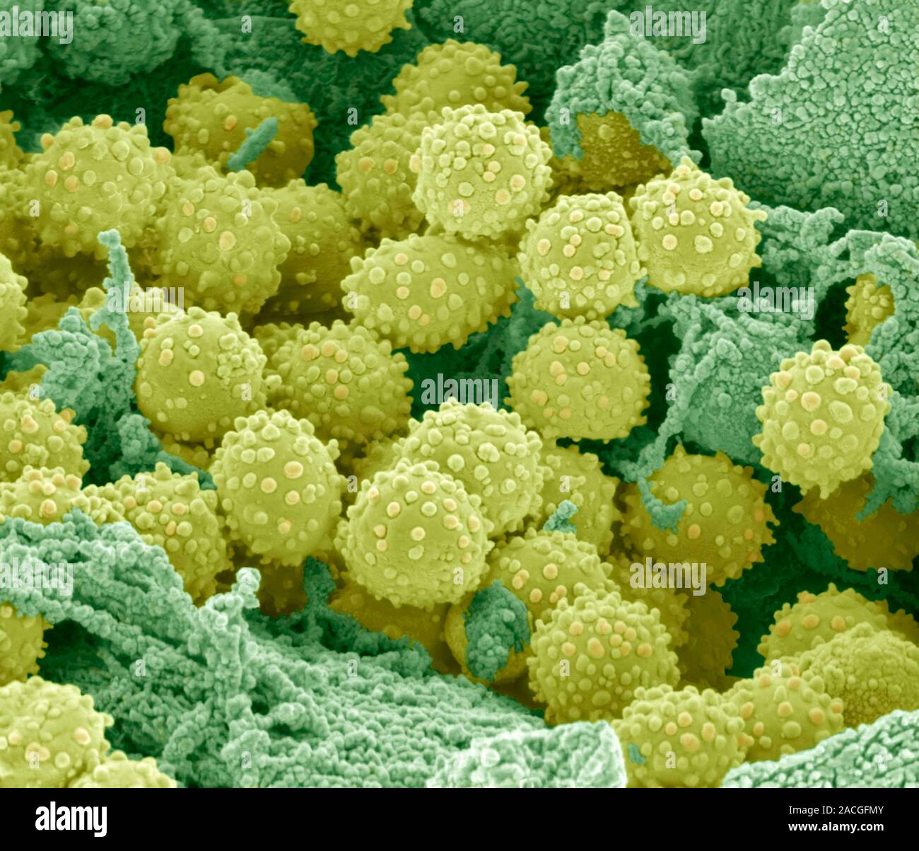 Lymphocytes in skin disorder, coloured scanning electron micrograph ...