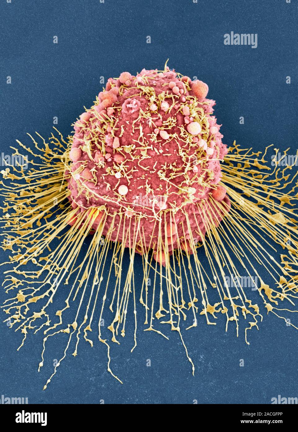 HeLa cell, coloured scanning electron micrograph (SEM). HeLa cells are ...