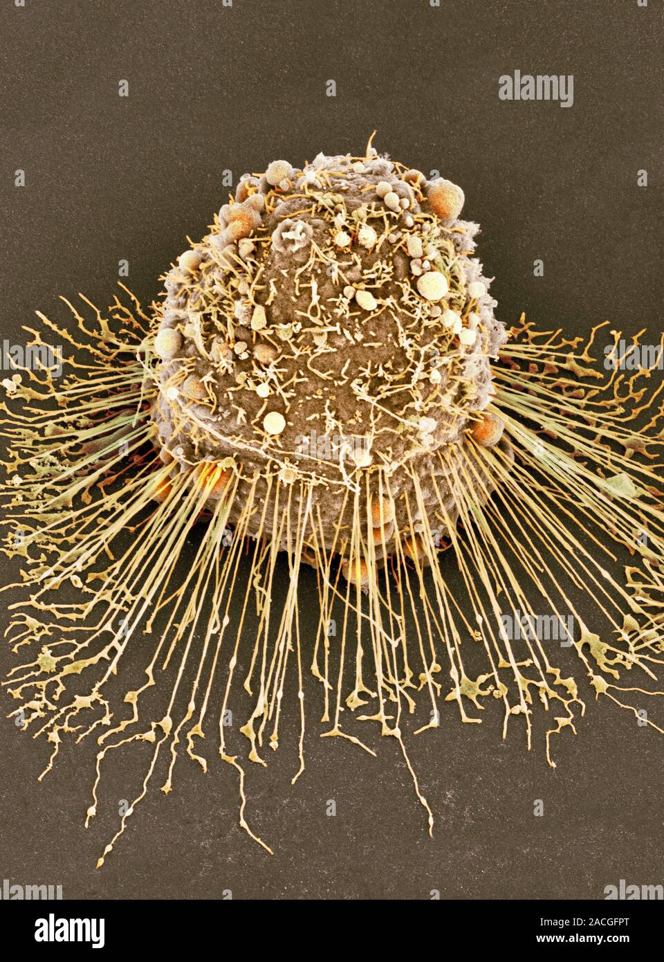 HeLa cell, coloured scanning electron micrograph (SEM). HeLa cells are ...