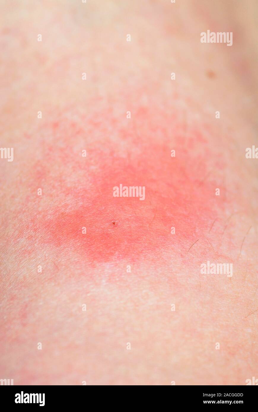 Bee sting. Bee stings can cause pain, redness and swelling for up to 48 ...