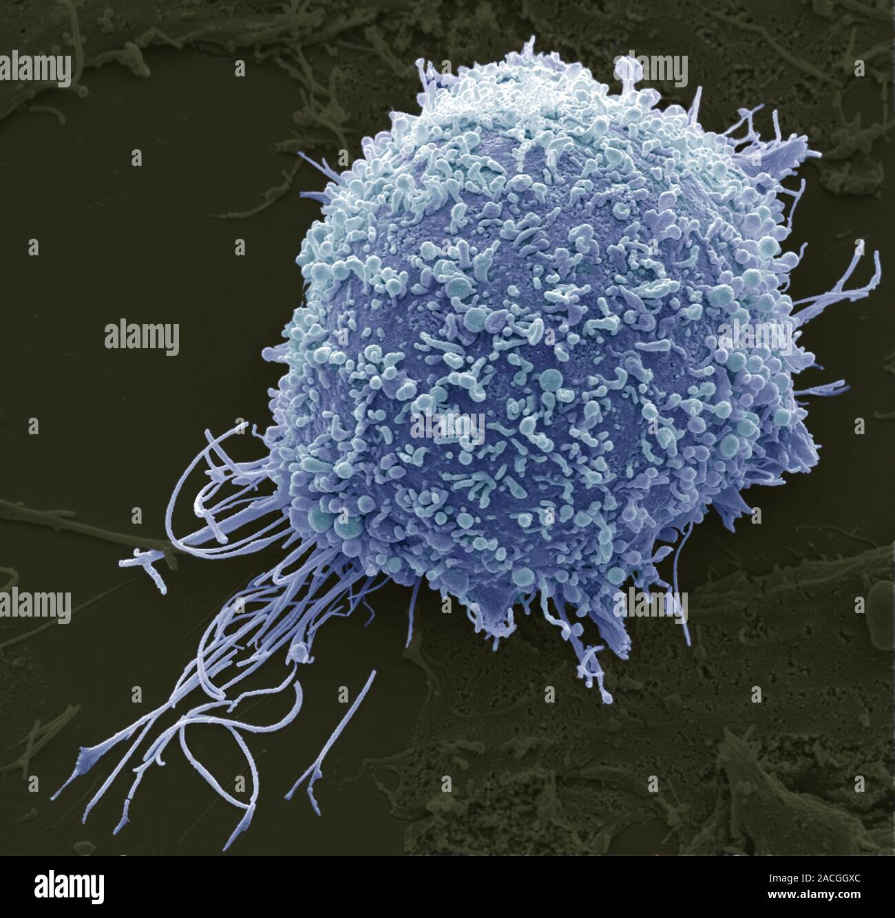 Cervical cancer cell, coloured scanning electron micrograph (SEM ...