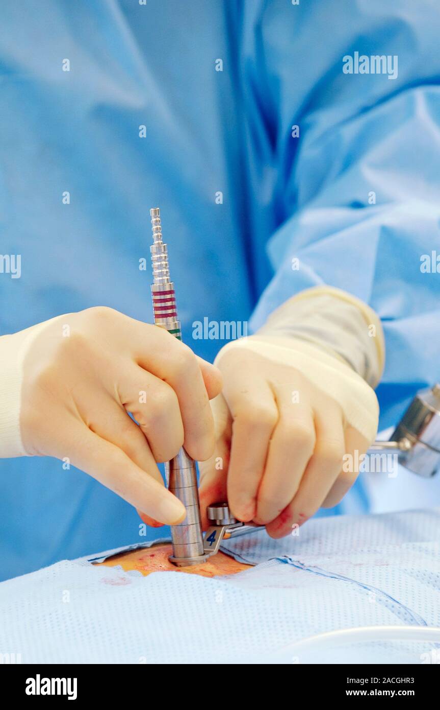 Slipped disc microendoscopy surgery. Surgeon performing an operation on ...