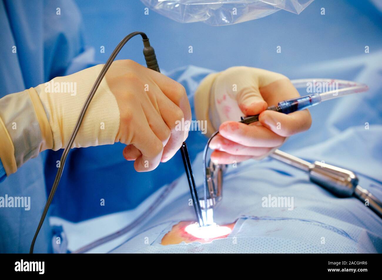 Slipped disc microendoscopy surgery. Surgeon performing an operation on ...