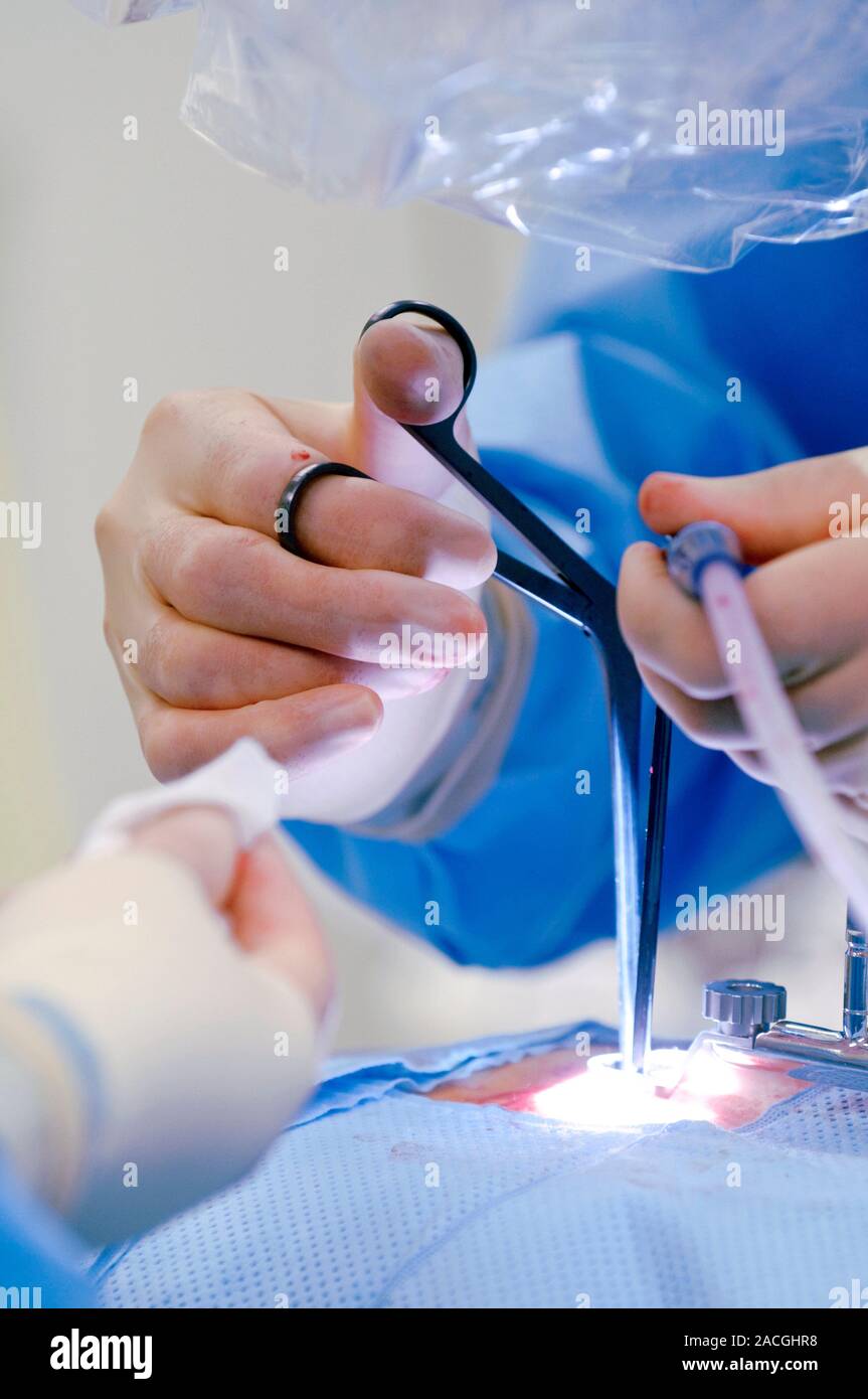 Slipped disc microendoscopy surgery. Surgeon performing an operation on ...