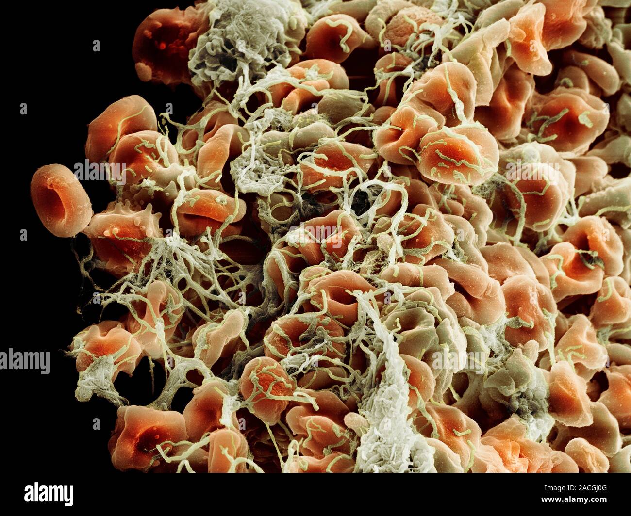 Blood clot. Coloured scanning electron micrograph (SEM) of a blood clot ...