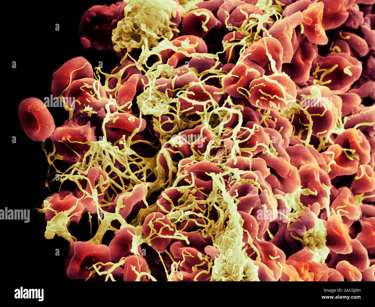 Blood clot. Coloured scanning electron micrograph (SEM) of a blood clot ...
