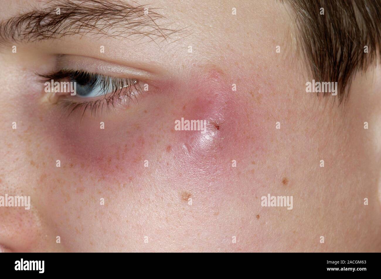 Infected insect bite on the cheek of a 14 year old male patient. The ...