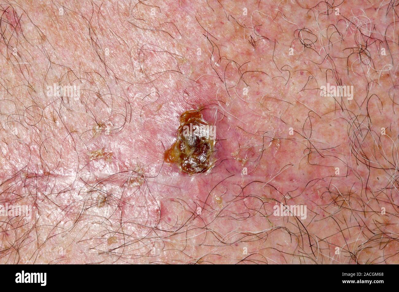 Close-up of an infected wound in the chest wall of a 60 year old male ...