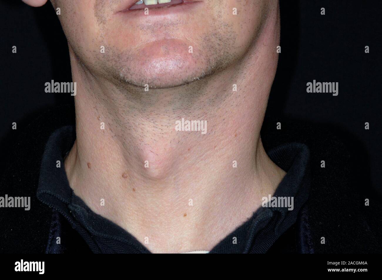 Swollen lymph nodes in the neck (cervical lymphadenopathy) in a 34 year ...