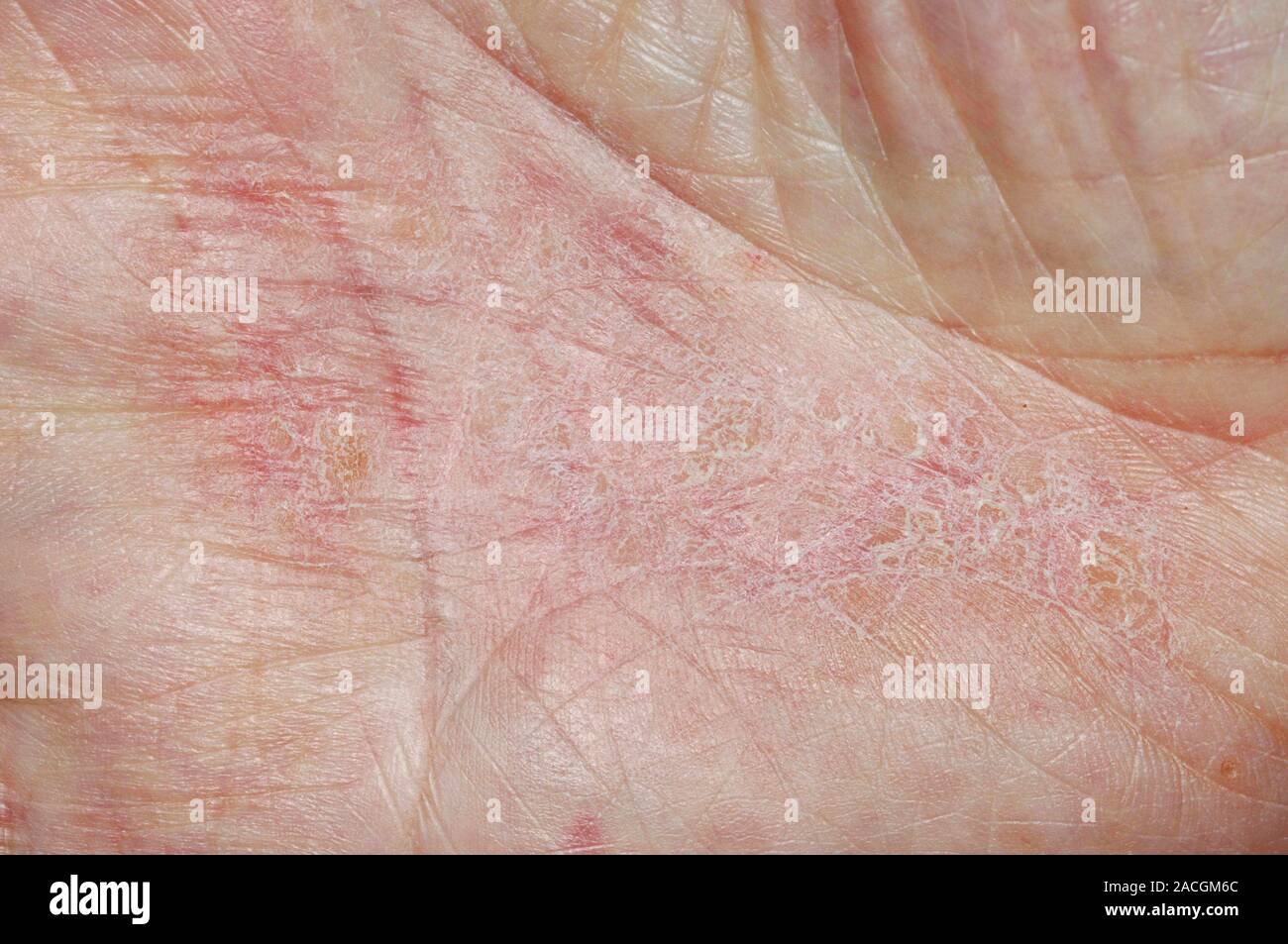 Close-up of the palm of the hand in a 74 year old male patient showing ...