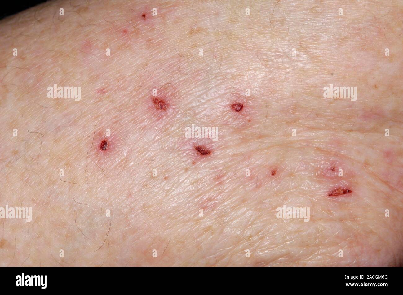 Close-up of scratch marks and blisters on the arm in a 72 year old ...