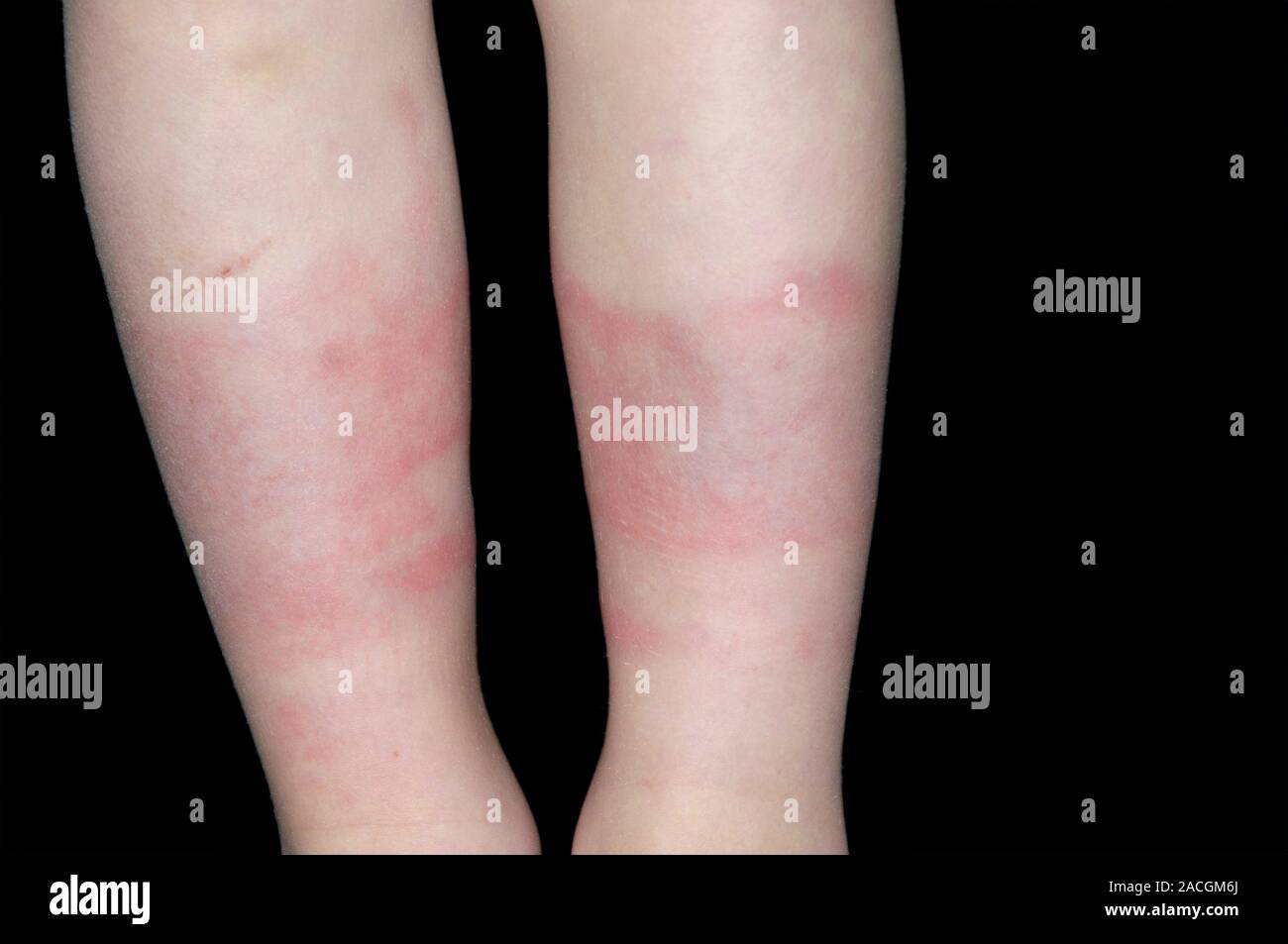 Urticaria on the skin of the shins of a 3 year old male patient caused ...
