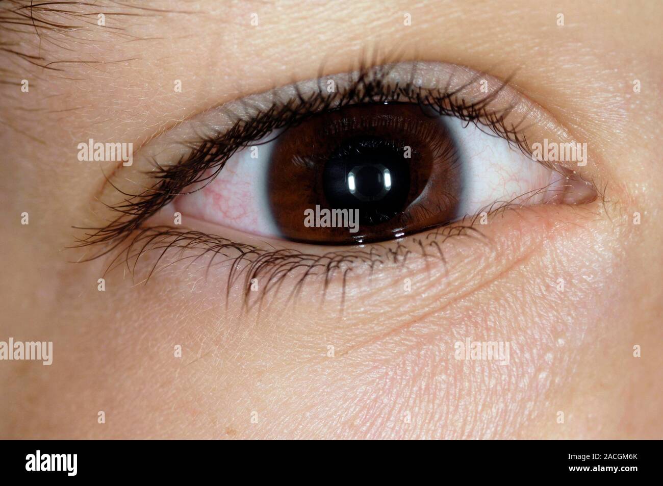 Close-up of the red eye in a 12 year old male patient due to hay fever ...