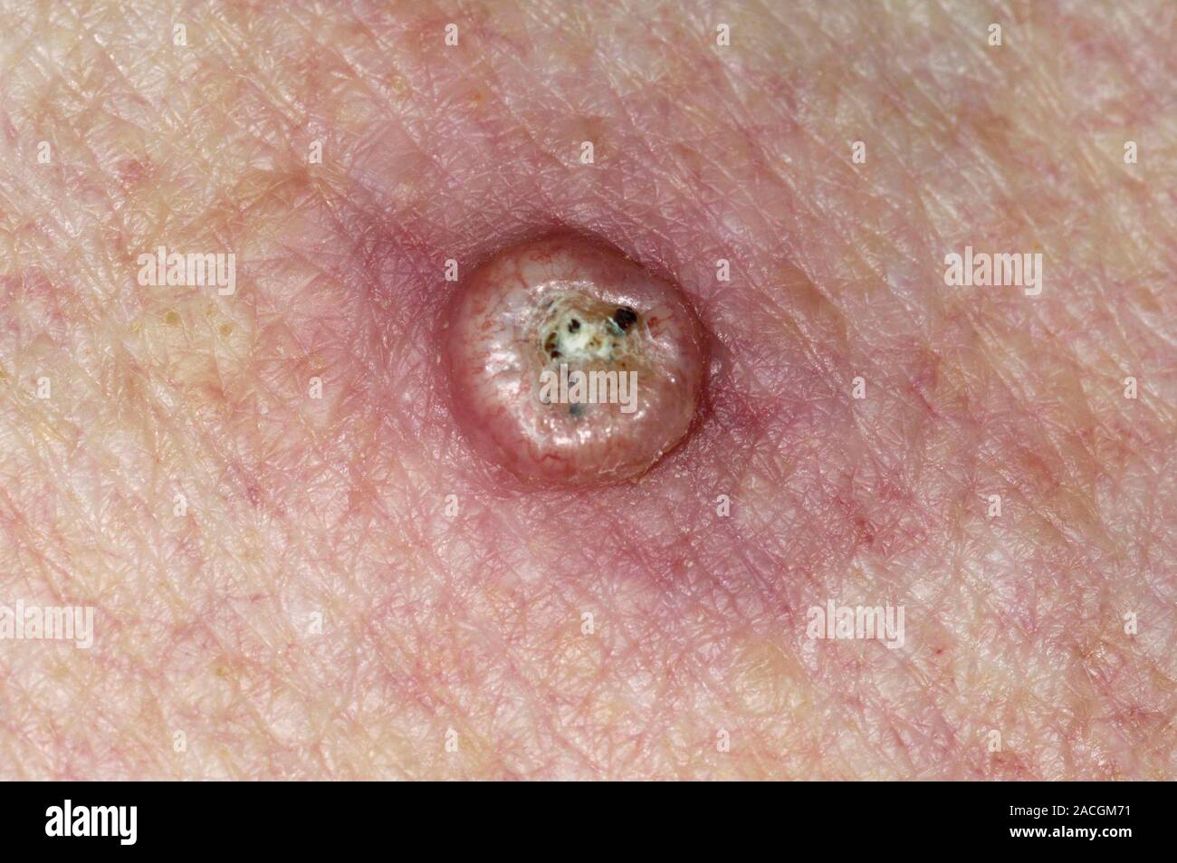 Close-up of a keratoacanthoma on the chest of an 82 year old male ...