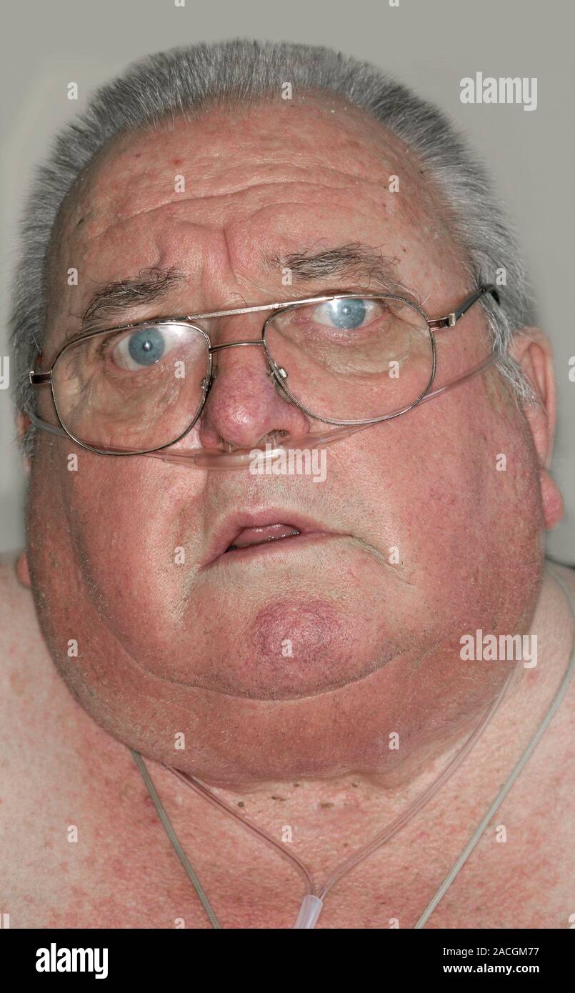 Thick neck in an obese 76 year old male patient with Pickwickian ...