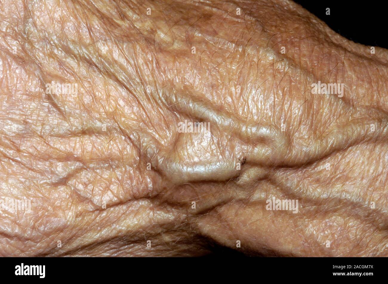Close-up of a ganglion on the wrist in an 82 year old male patient ...