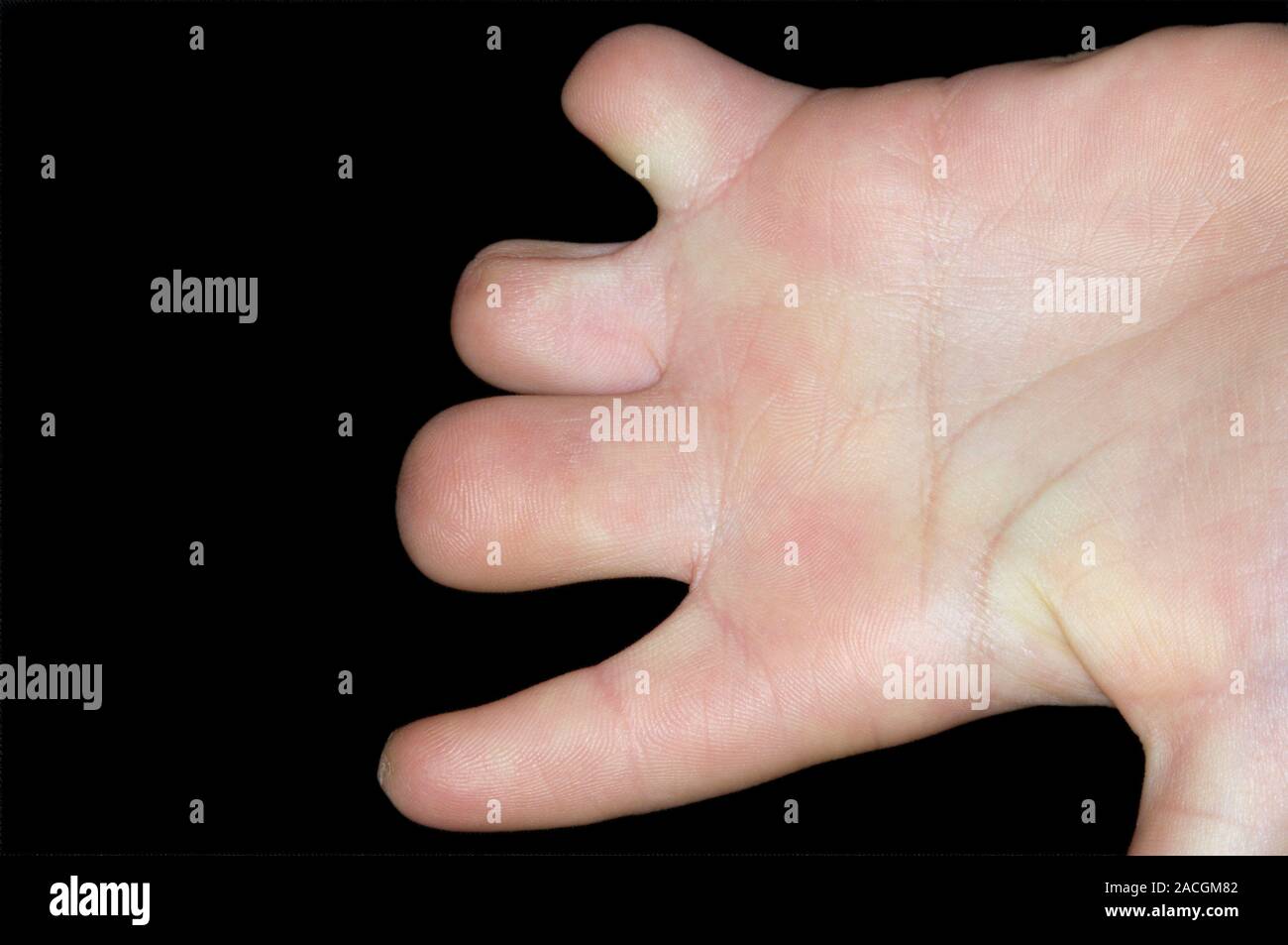 Deformed fingers on the hand of an 8 year old male patient caused by ...