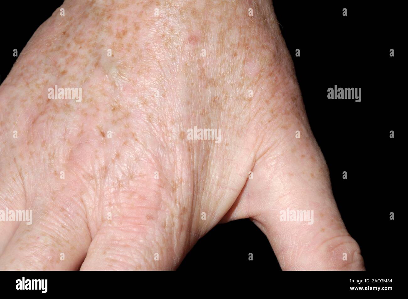 Wasting of the fleshy eminence at the base of the thumb (thenar ...