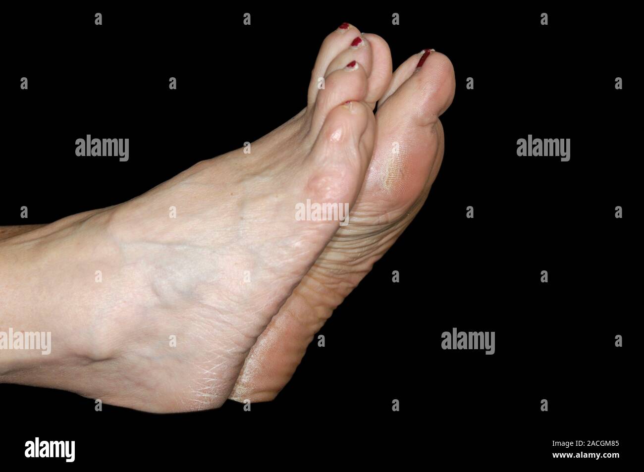 Unequal length of legs in a 63 year old female patient, due to slipped ...