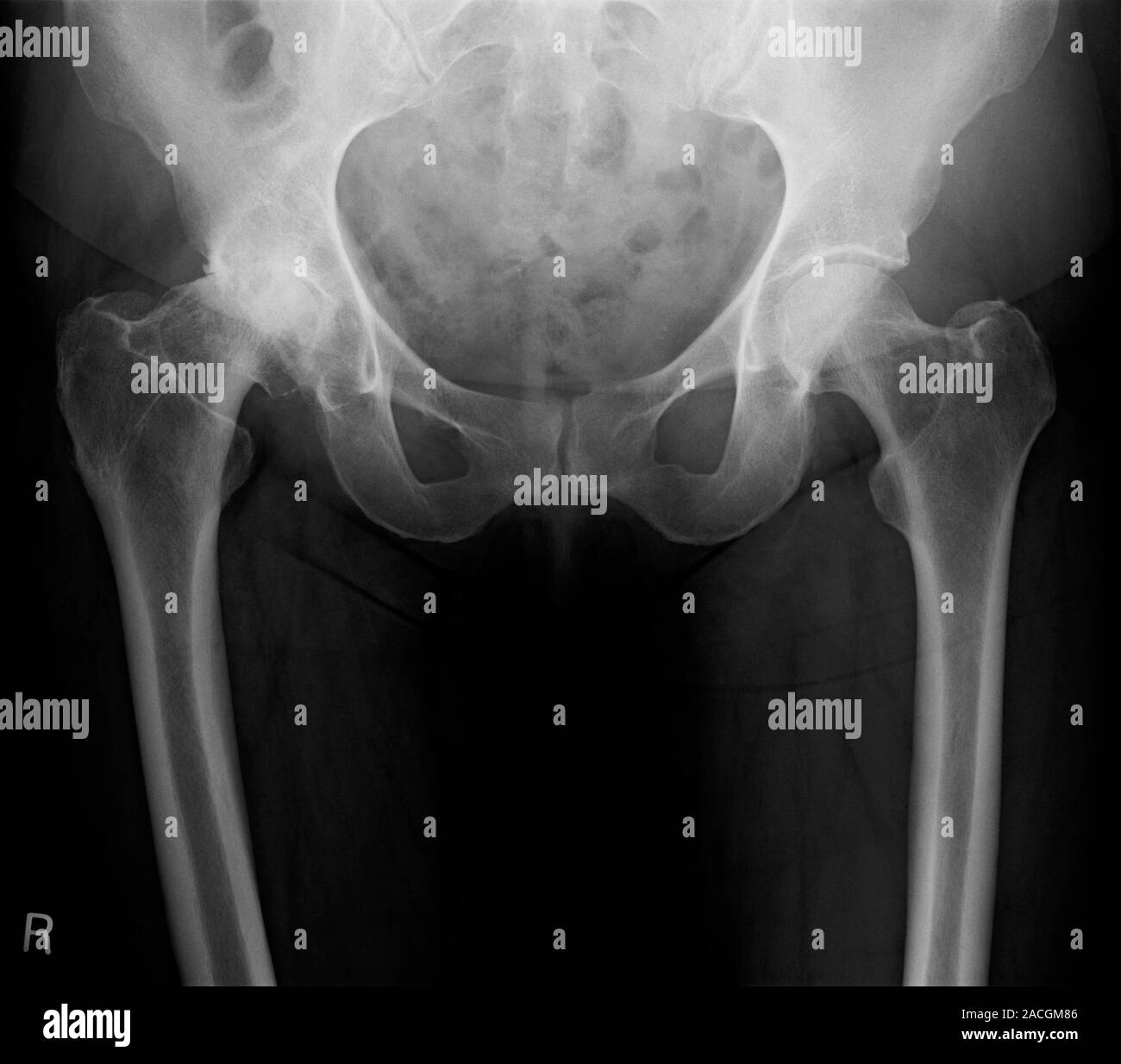 X-ray (front view) of the pelvis in a 63 year old female patient ...