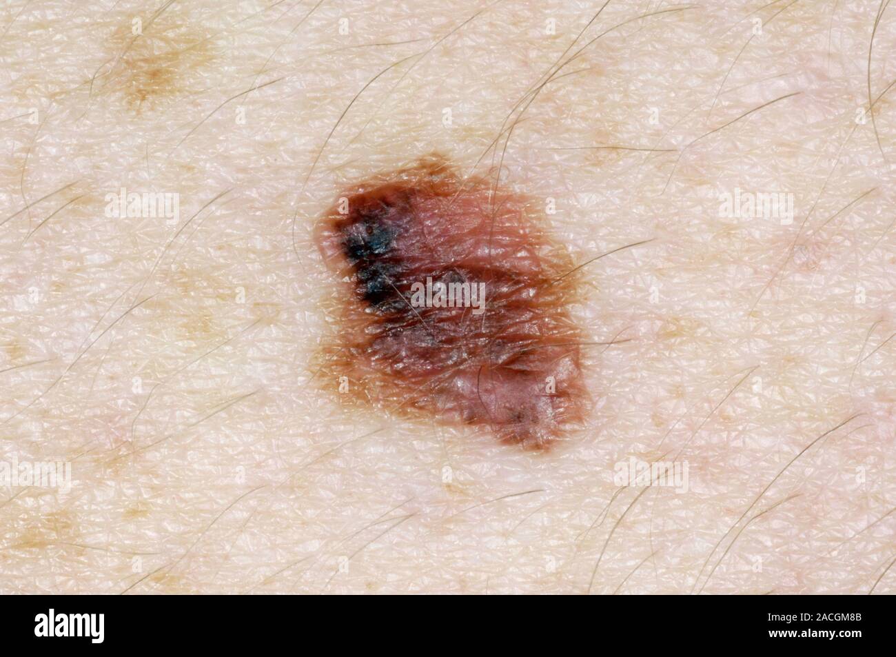 Close-up of malignant melanoma on the skin of the arm in a 46 year old ...