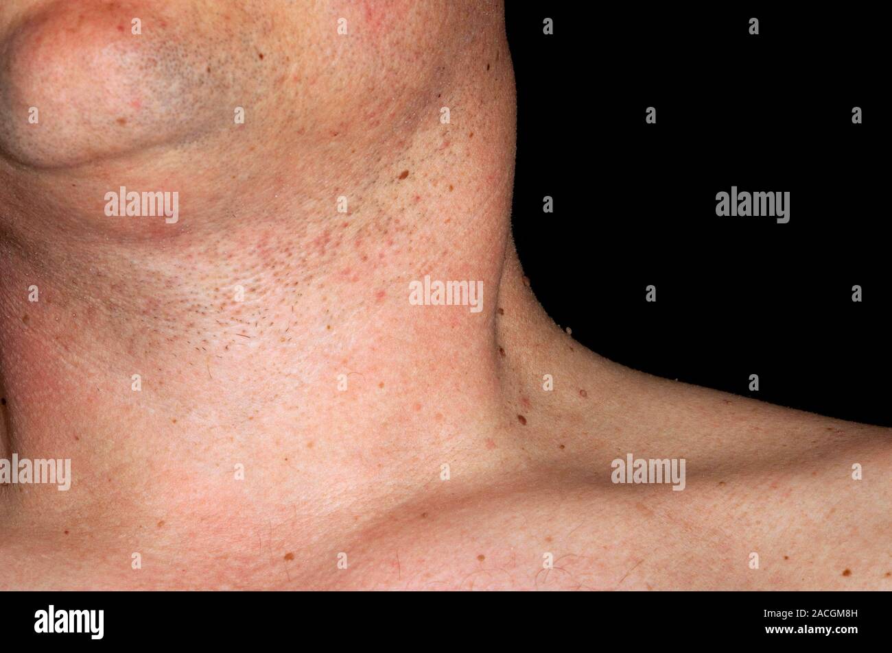 Swelling in the neck in a 39 year old male patient due to secondary ...