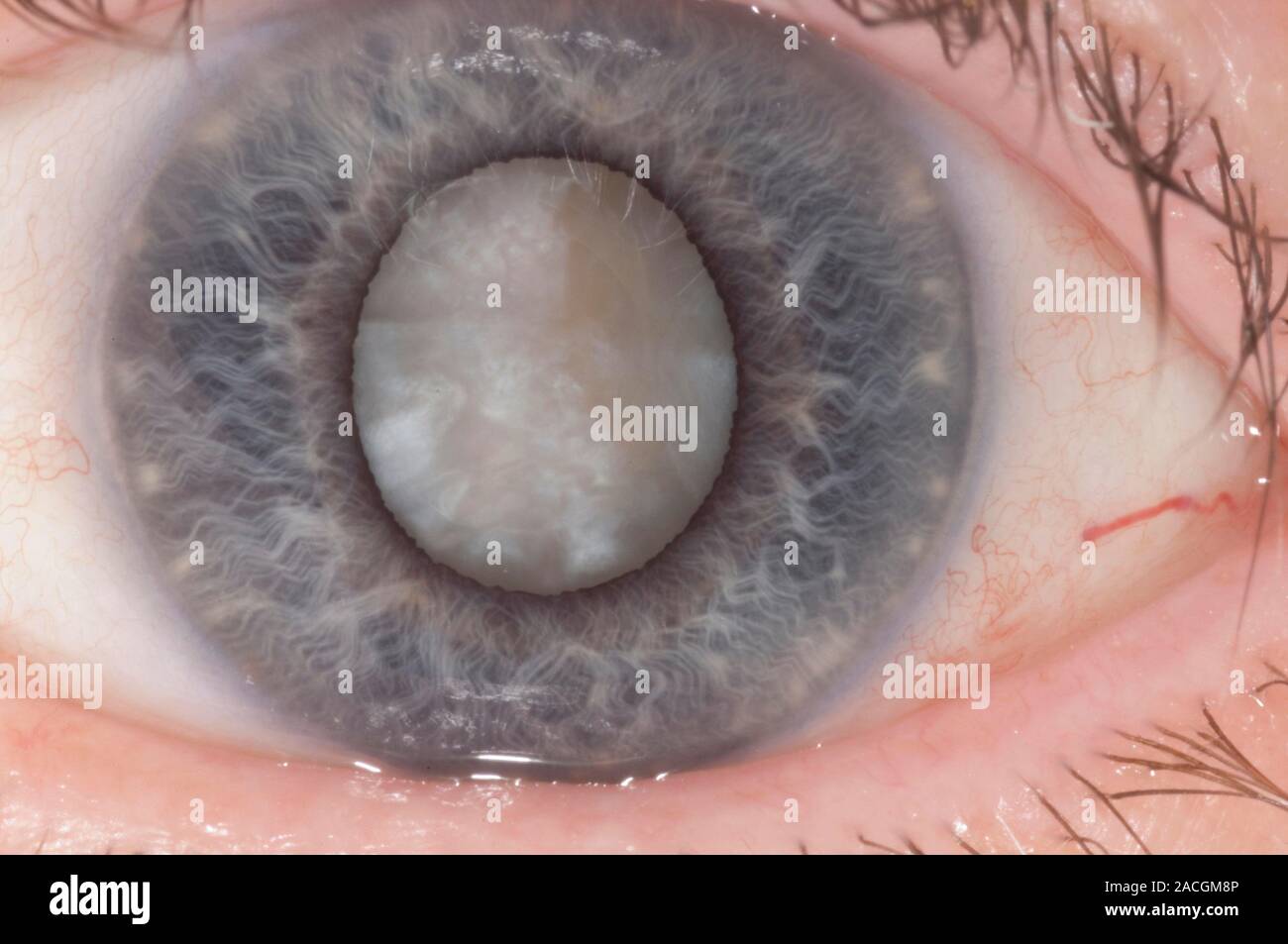 Close-up of the eye in a 68 year old female patient showing a dense ...