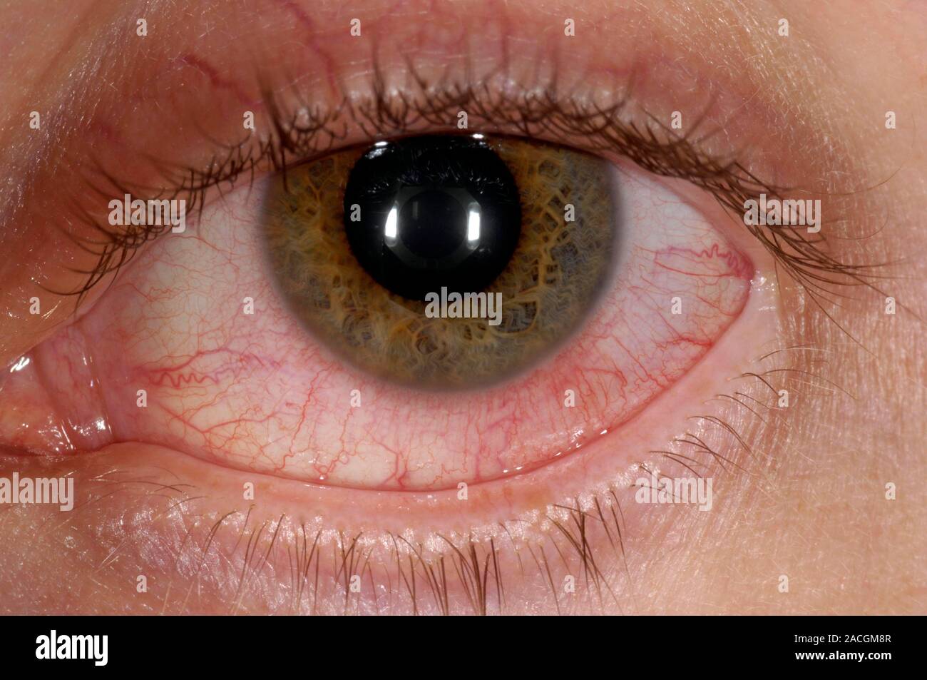 Close Up Of The Reddened Eye Of A 34 Year Old Male Patient With Acute Conjunctivitis