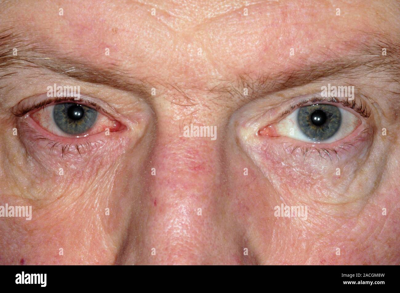 Inflamed eyelids (at left) with dry and red eye in 57 year old male ...