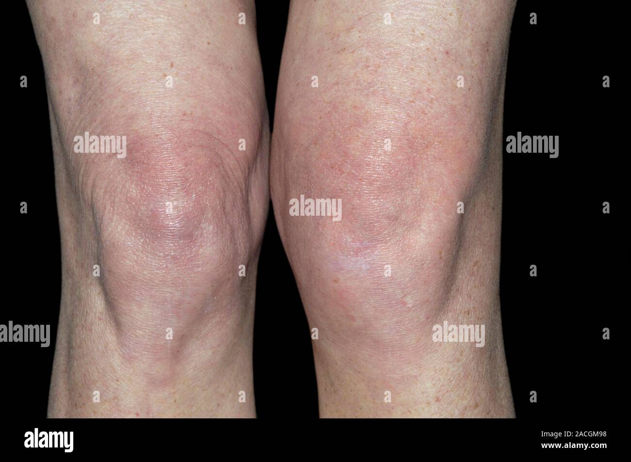 Swollen joint of the knee (at right) in a 58 year old female patient ...