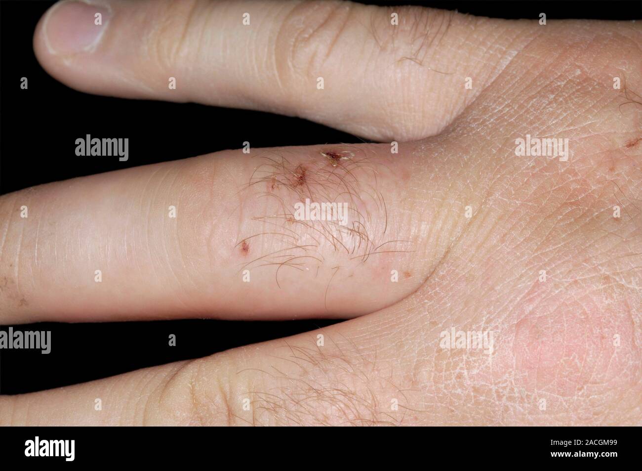 Cat bite wound on the finger of a 45 year old male patient after one ...