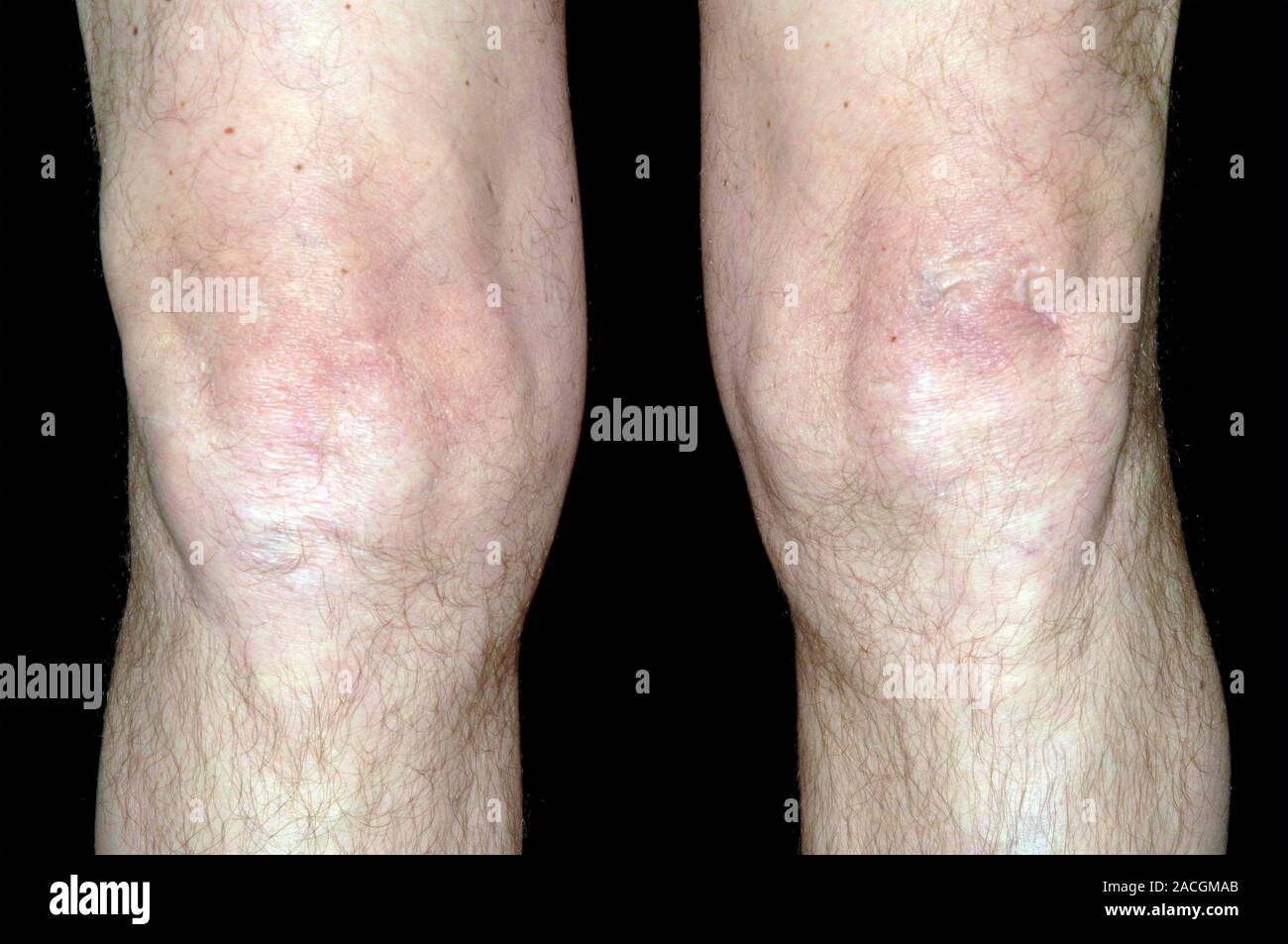 Swollen joint of the knee (at left) in a 61 year old male patient due ...