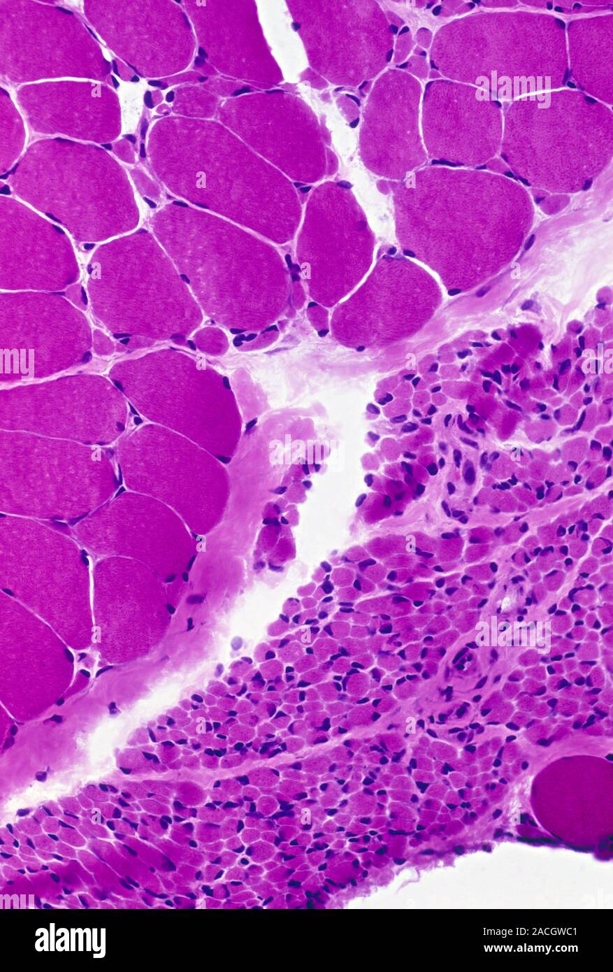 Muscular atrophy. Light micrograph of a section through muscle fibres ...