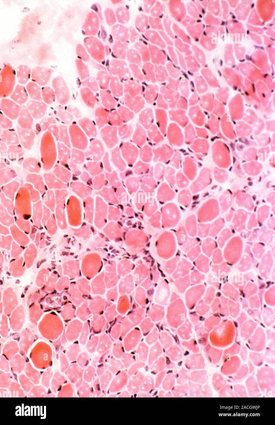 Muscular dystrophy. Light micrograph of a section through muscle tissue ...