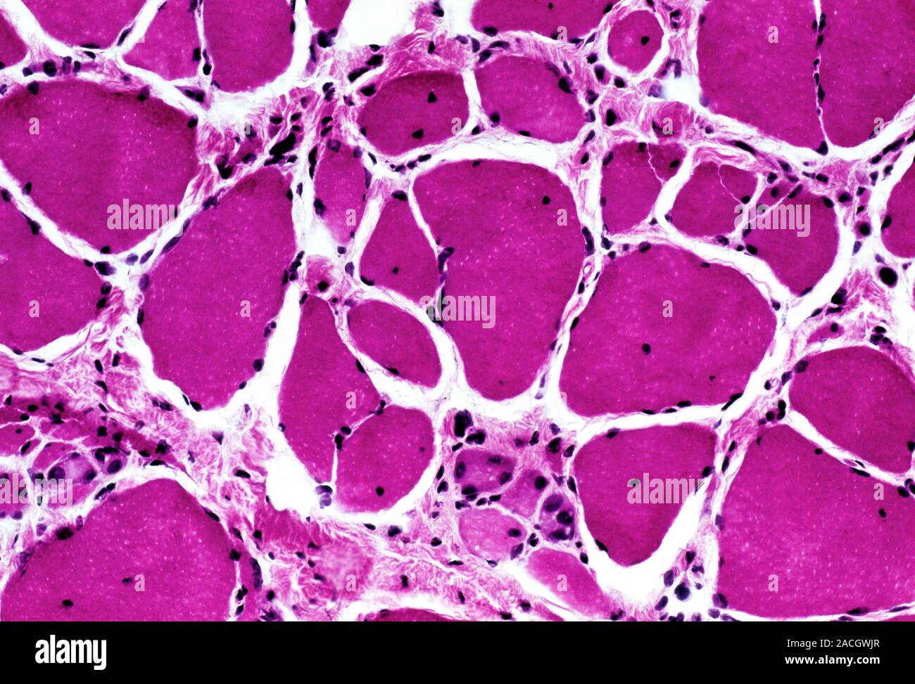 Muscular dystrophy. Light micrograph of a section through muscle tissue ...