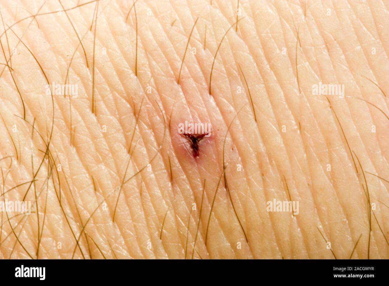 Bite mark on human skin from a Medicinal Leech showing typical Y-shaped pattern. These leeches ...
