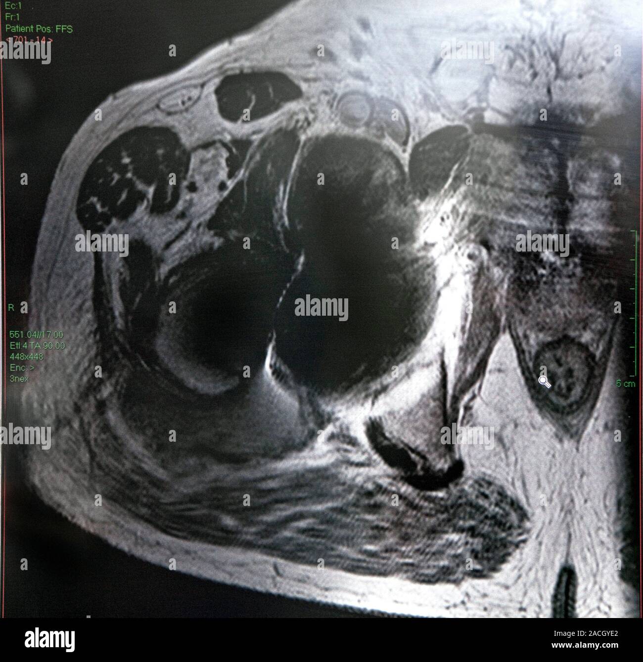 Failed hip replacement. Axial magnetic resonance imaging (MRI) scan ...
