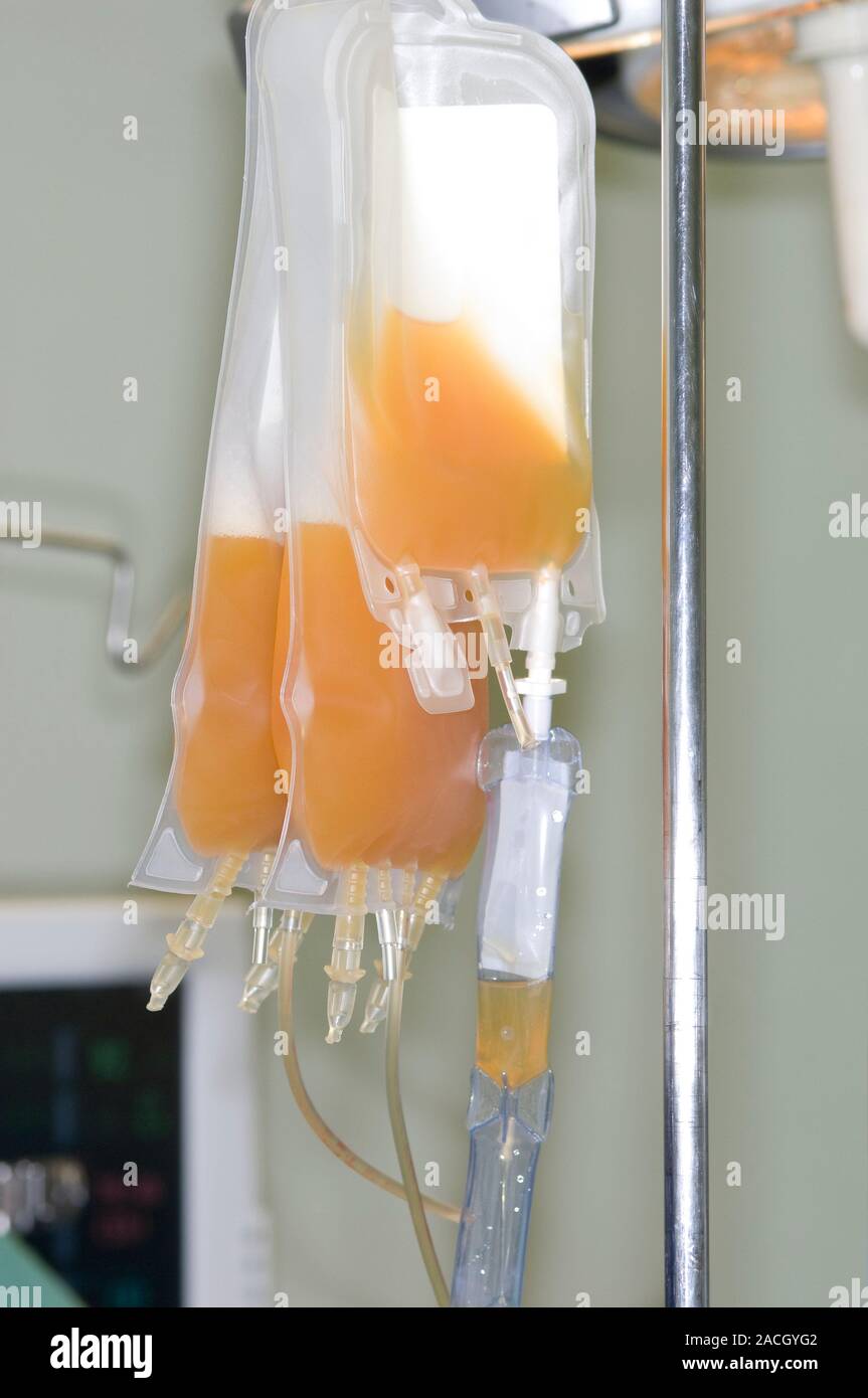 Blood platelets ready for transfusion during surgery. Platelets ...