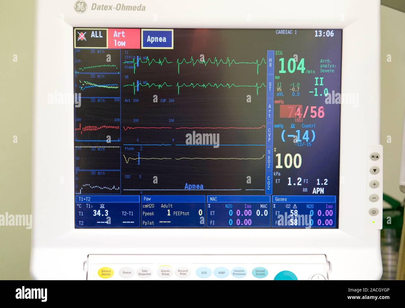 Vital signs monitor. This screen shows a patient's vital signs ...