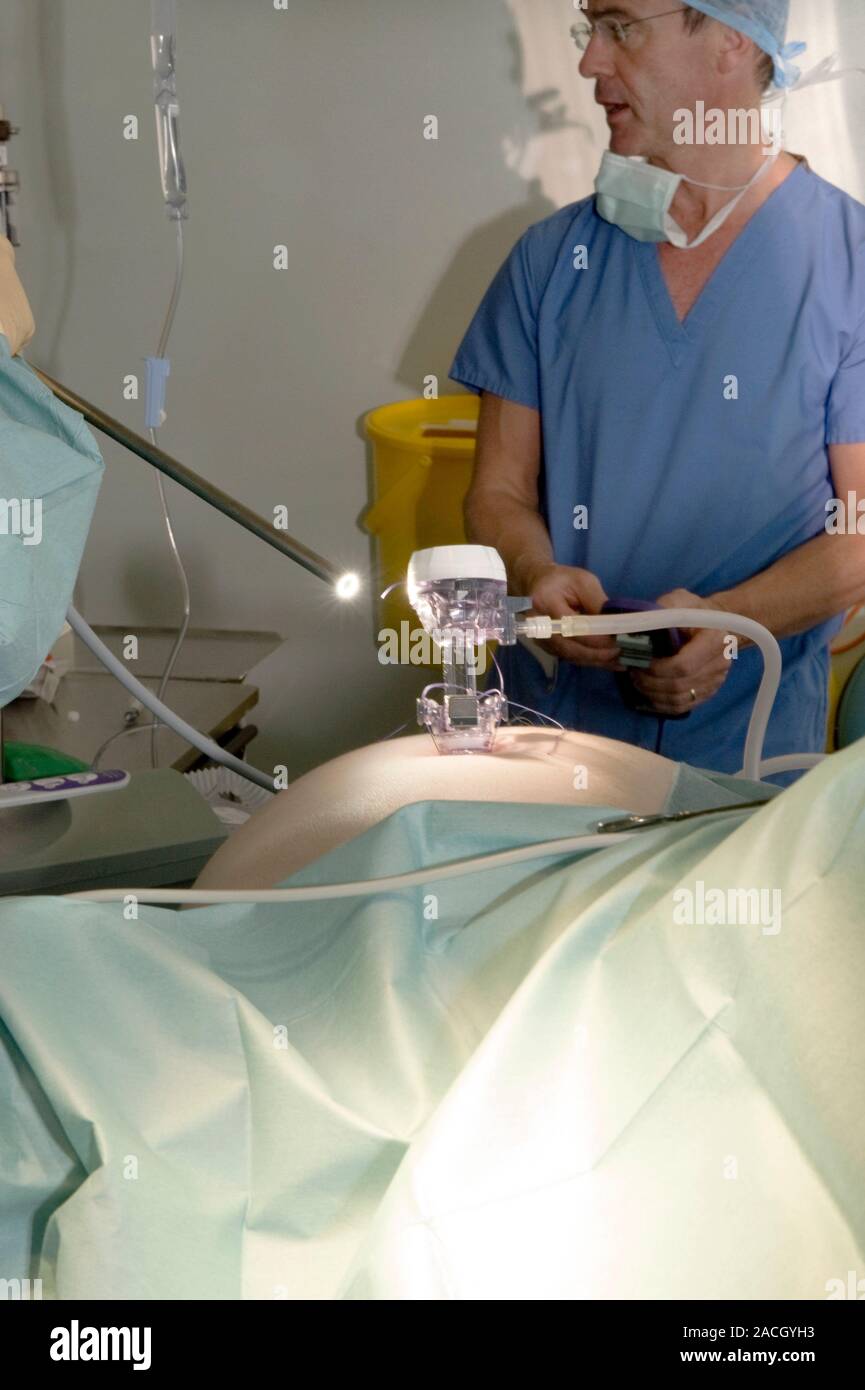 Laparoscopic colon cancer surgery. Surgeon preparing to insert an ...