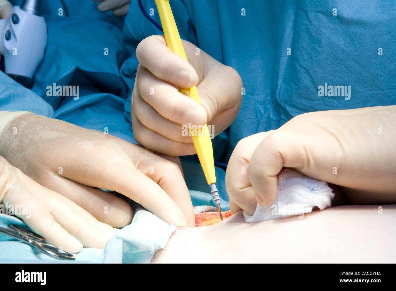 Laparoscopic colon cancer surgery. Surgeon making an incision in a ...