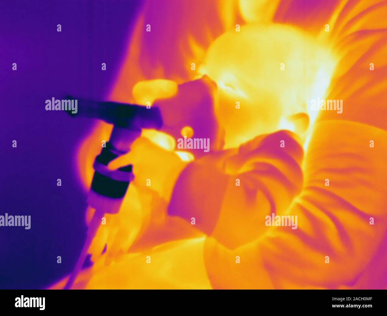 Thermogram - Infant using nebulizer - The colors show temperature ...