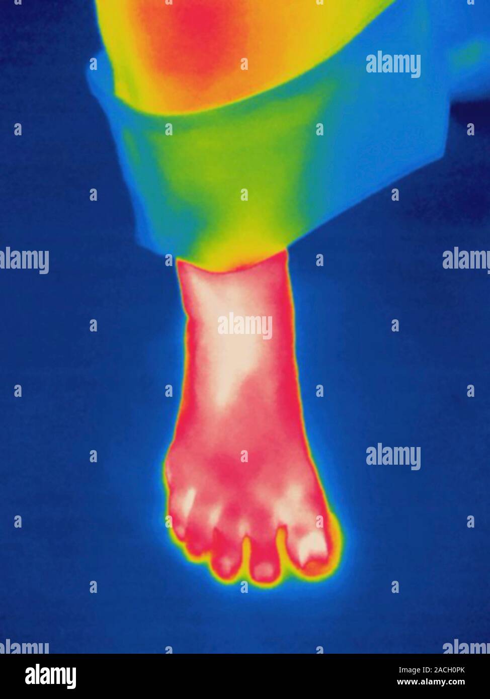 Thermogram - Adult female's foot - The colors show temperature ...