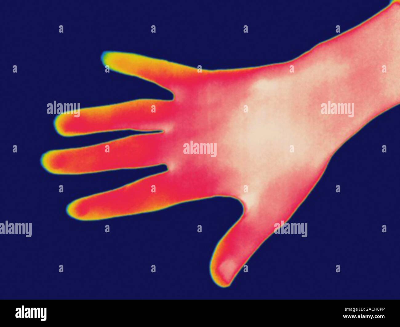 Thermogram of a human hand. The colors show temperature variation with ...