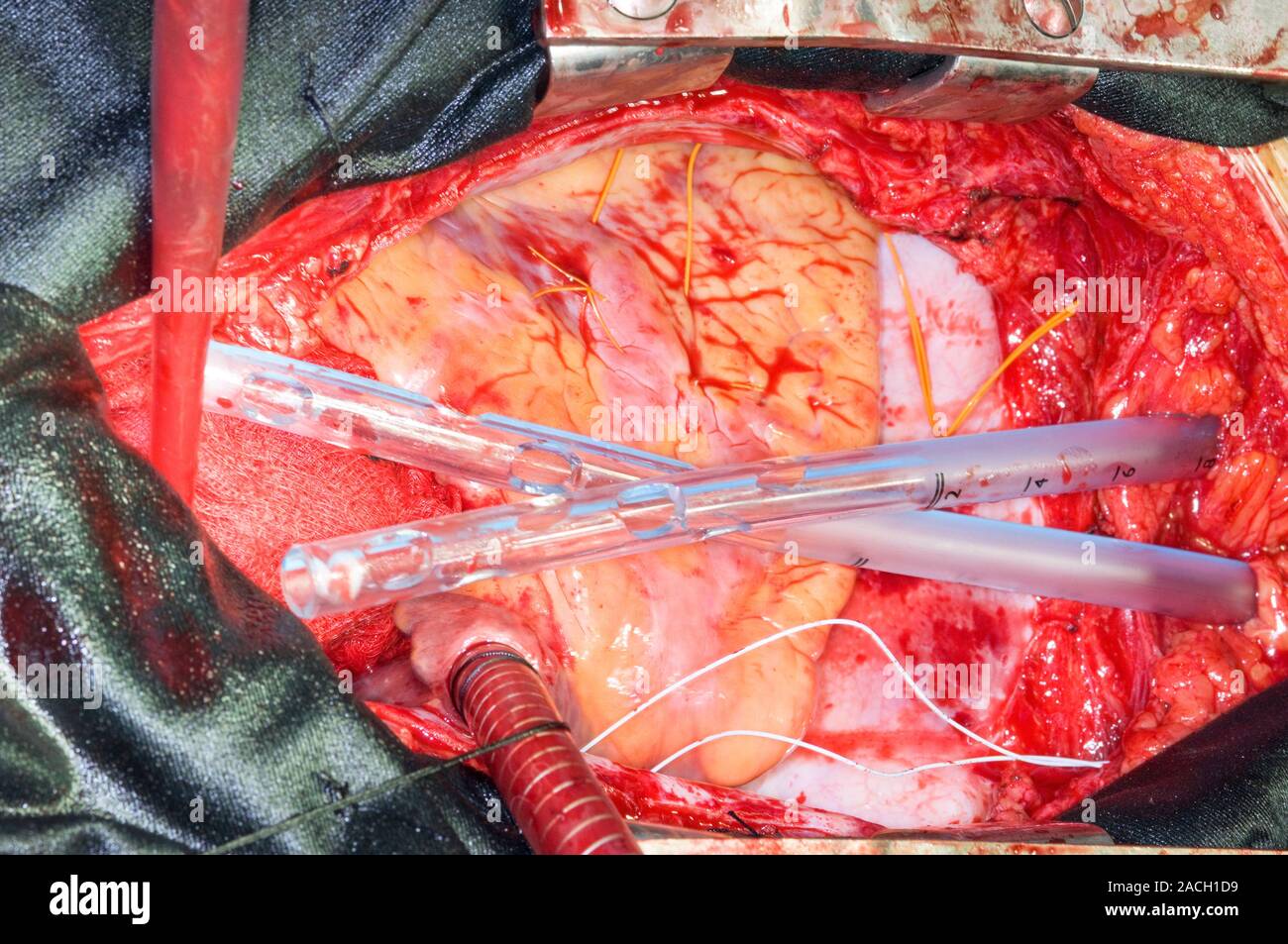 Open heart surgery. This surgery is being carried out to replace a ...