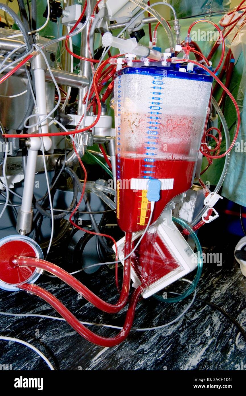Heart-lung machine in use during heart surgery. A heart-lung machine ...
