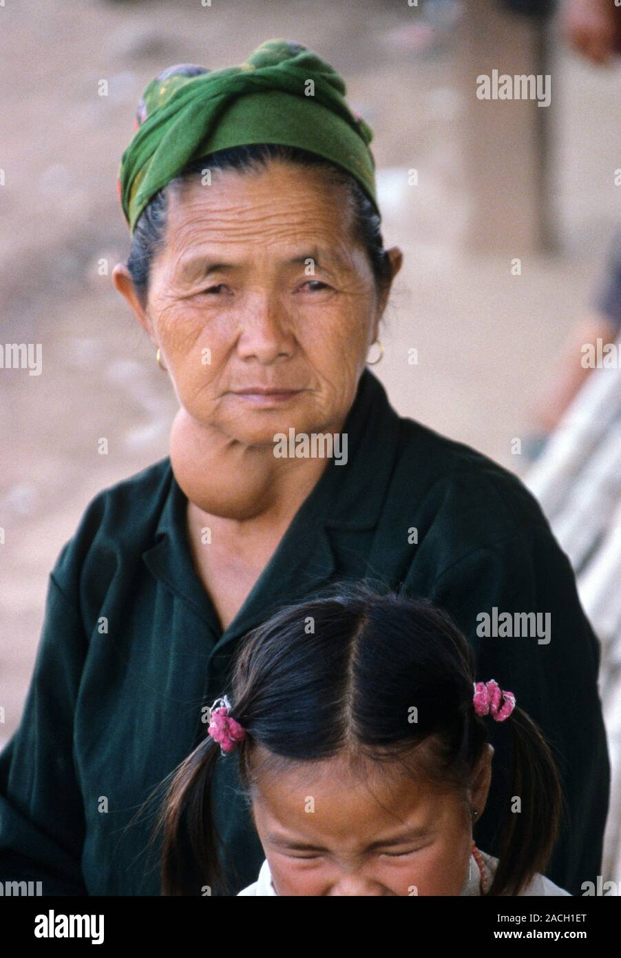 Woman with a goitre, a swelling of the neck caused by the enlargement ...