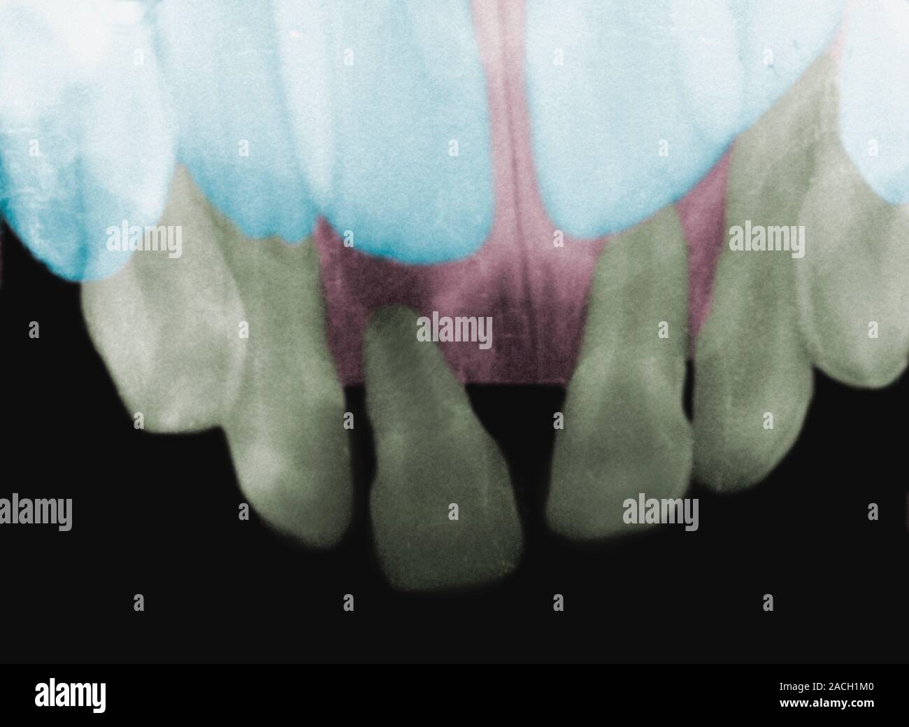 Dental X-ray showing baby teeth with adult teeth behind them Stock ...